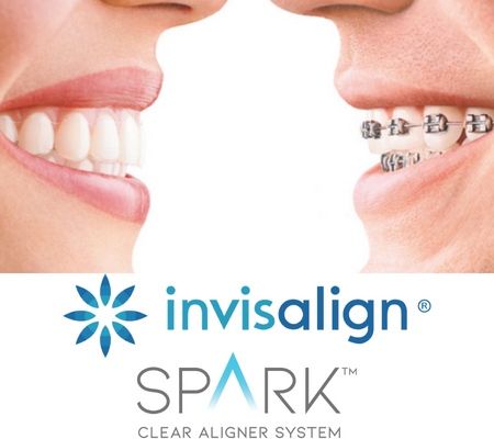 Orthodontics - Invisalign & Spark Aligners | Mascot Dental Clinic